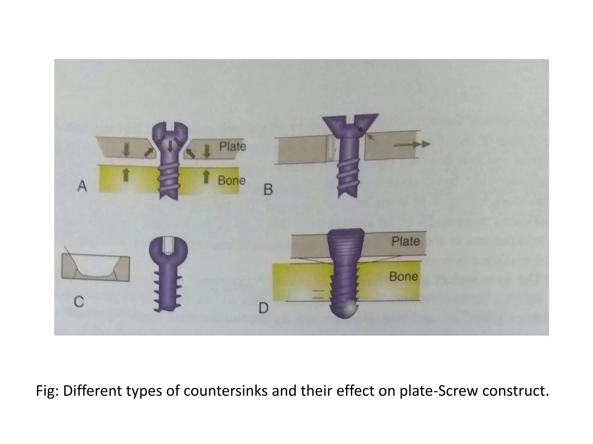 Anatomy of a bone screw, cortical screw vs cancellous screw, wood screw ...