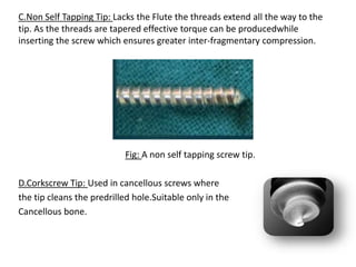 Anatomy of a bone screw, cortical screw vs cancellous screw, wood screw ...
