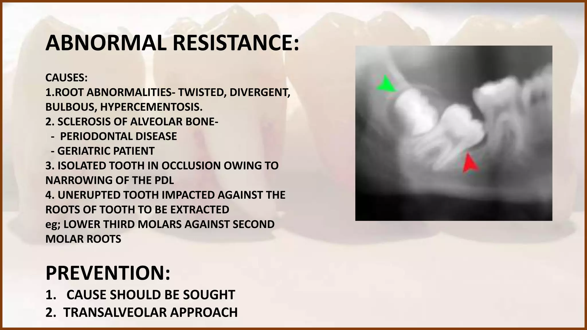 Complication of Tooth extraction and management | PPTX