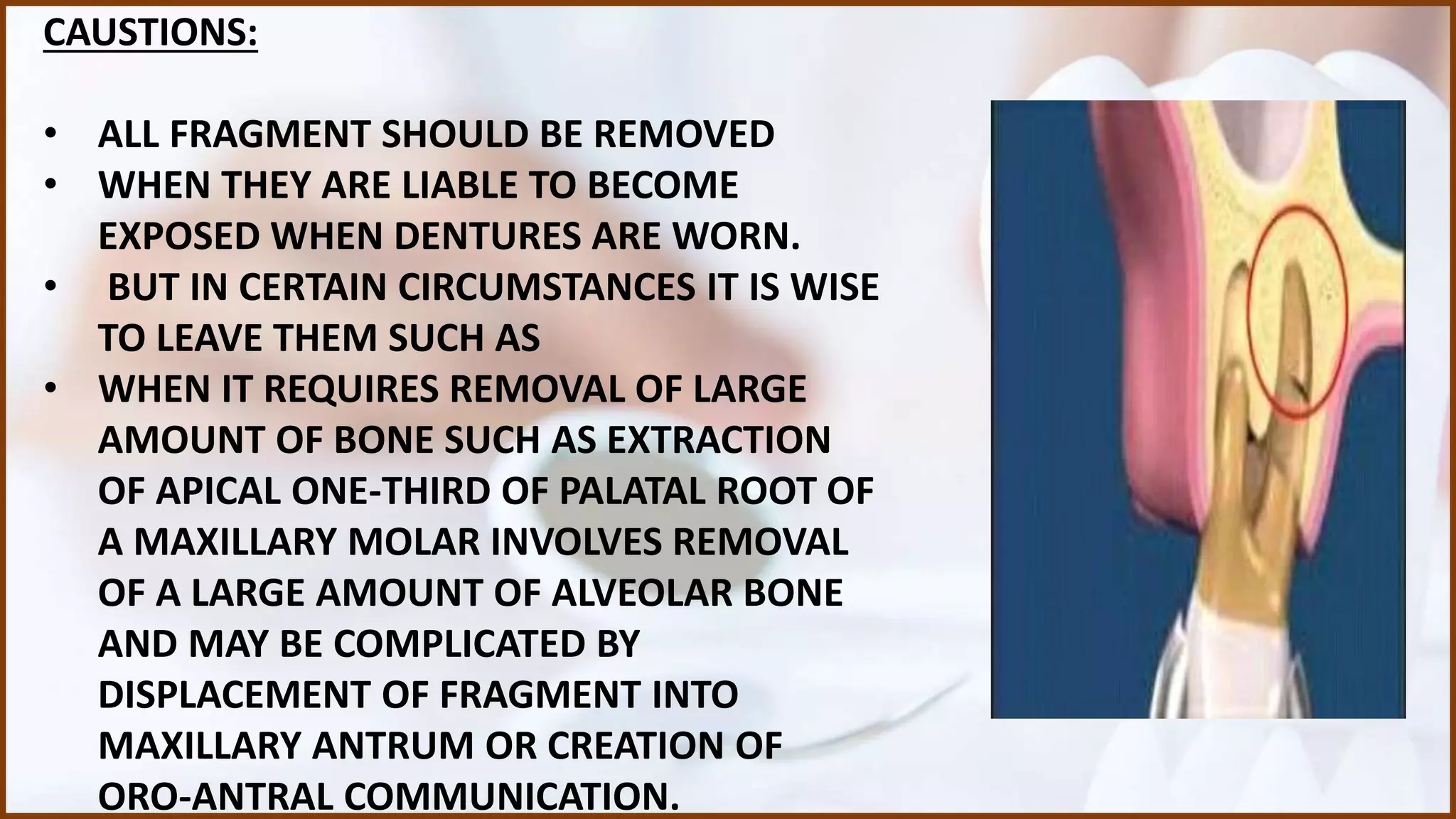 Complication of Tooth extraction and management | PPTX