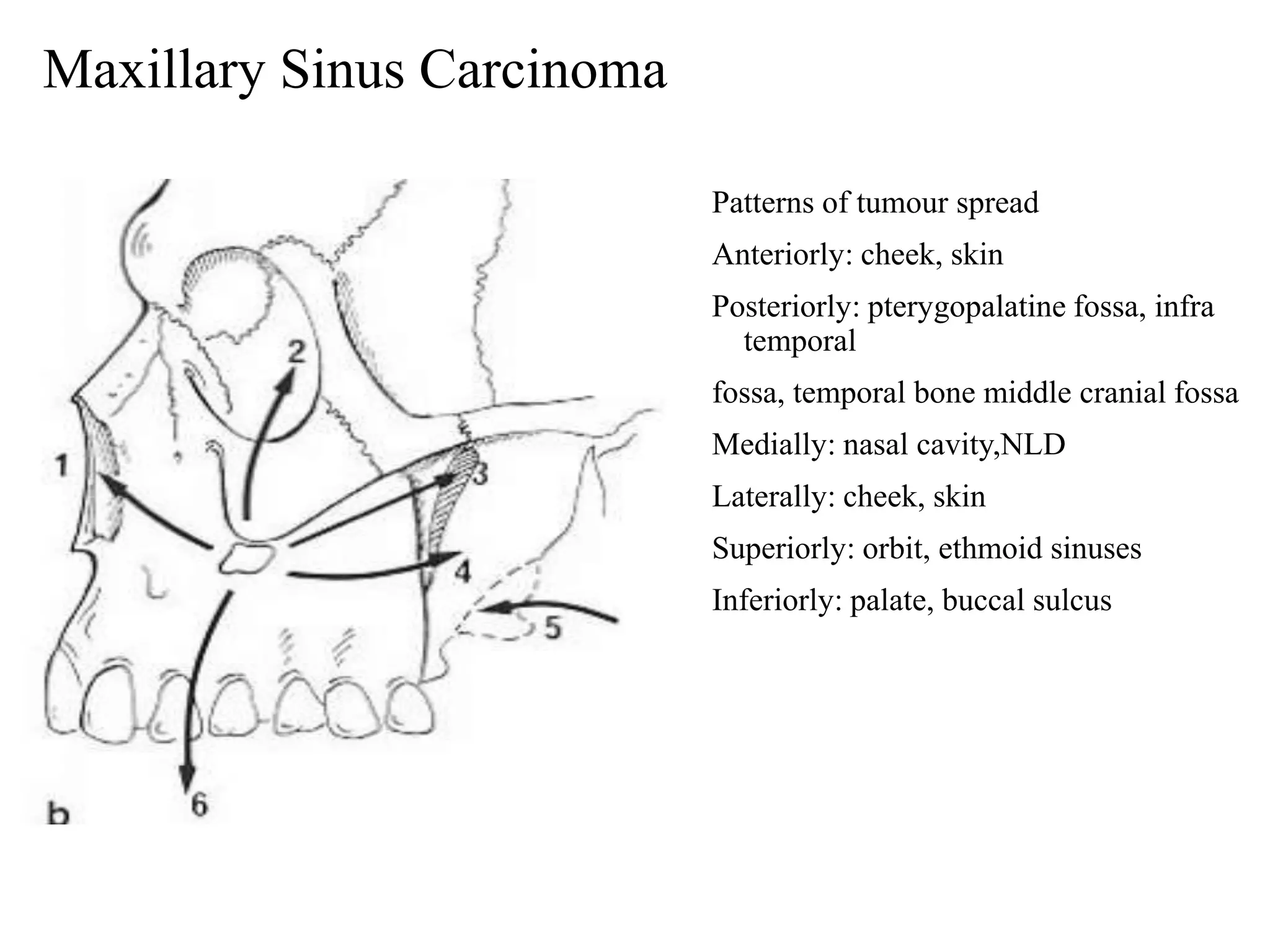 Management Carcinoma Nose & PNS | PPTX