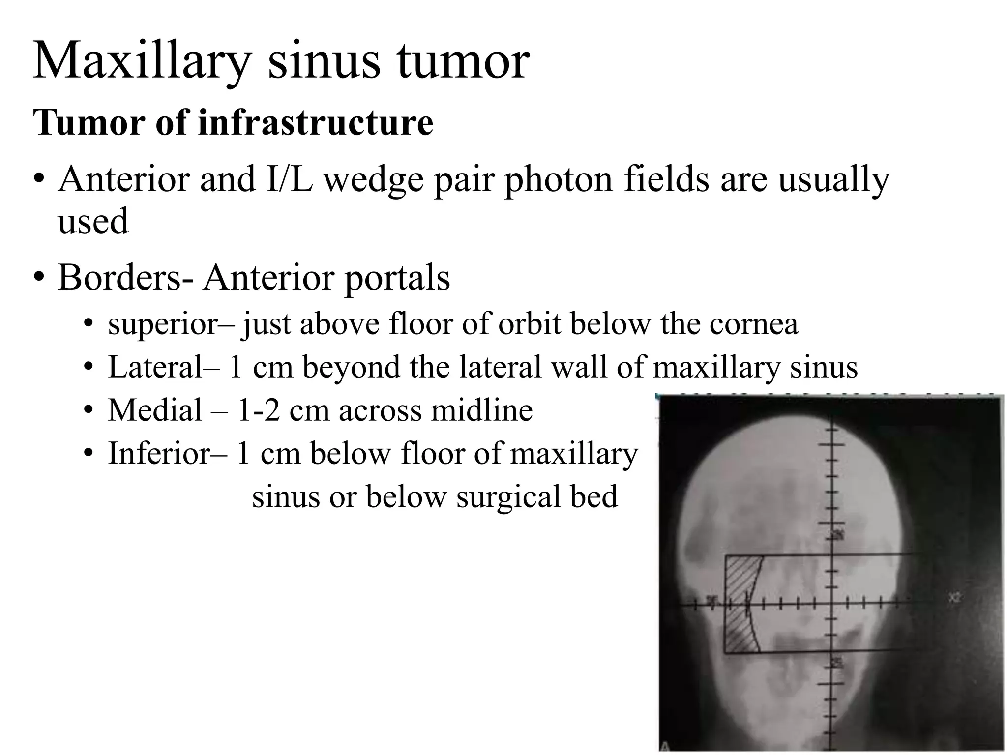 Management Carcinoma Nose & PNS | PPTX