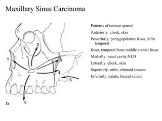 Management Carcinoma Nose & PNS | PPTX