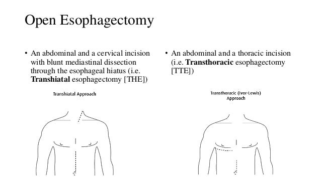 Satyajeet oesophagus management