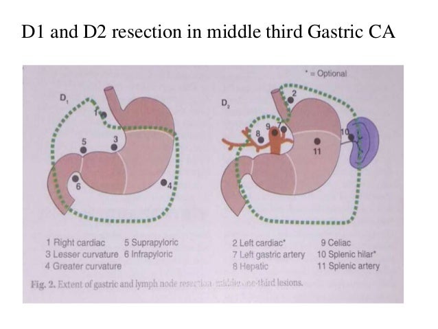 Satyajeet Carcinoma Stomach management
