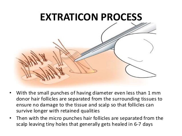 Satyam Follicular Unit Extraction Procedure