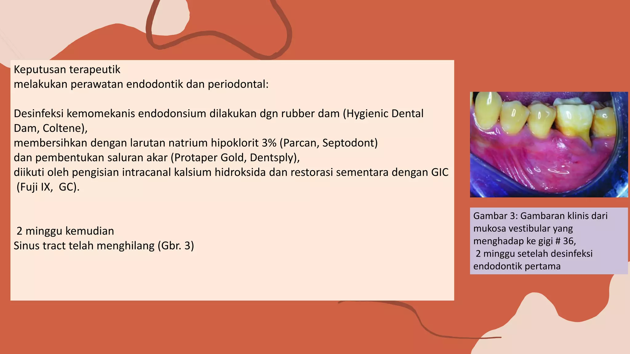 Savana lesi endo perio | PPTX