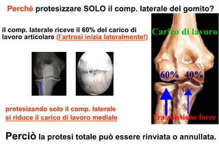 Protesi laterale di rivestimento del gomito | PDF