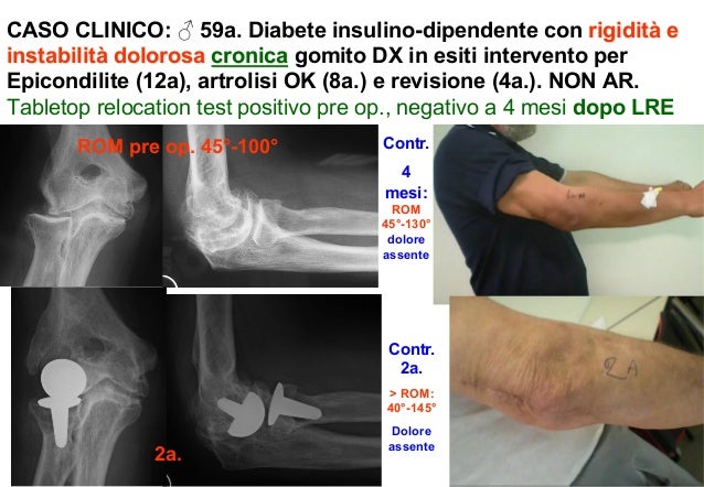 Protesi laterale di rivestimento del gomito
