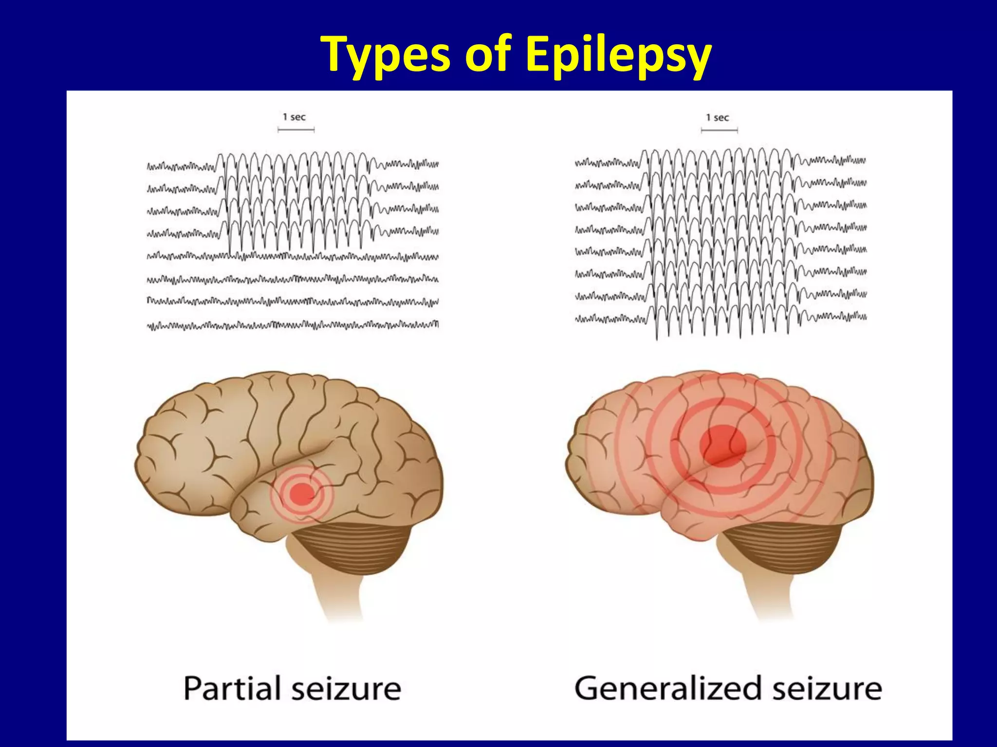 Types of Epilepsy and Choice of Antiepileptics in different Seizures | PDF