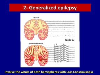 Types of Epilepsy and Choice of Antiepileptics in different Seizures | PDF
