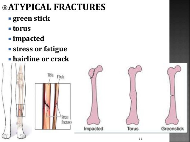 Fracture