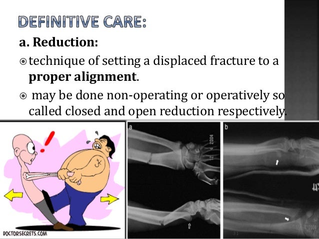 Fracture