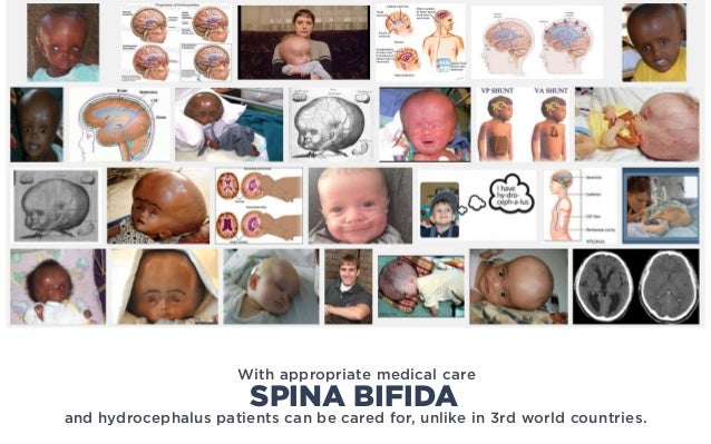 Current problems with the spina bifida diagnosis