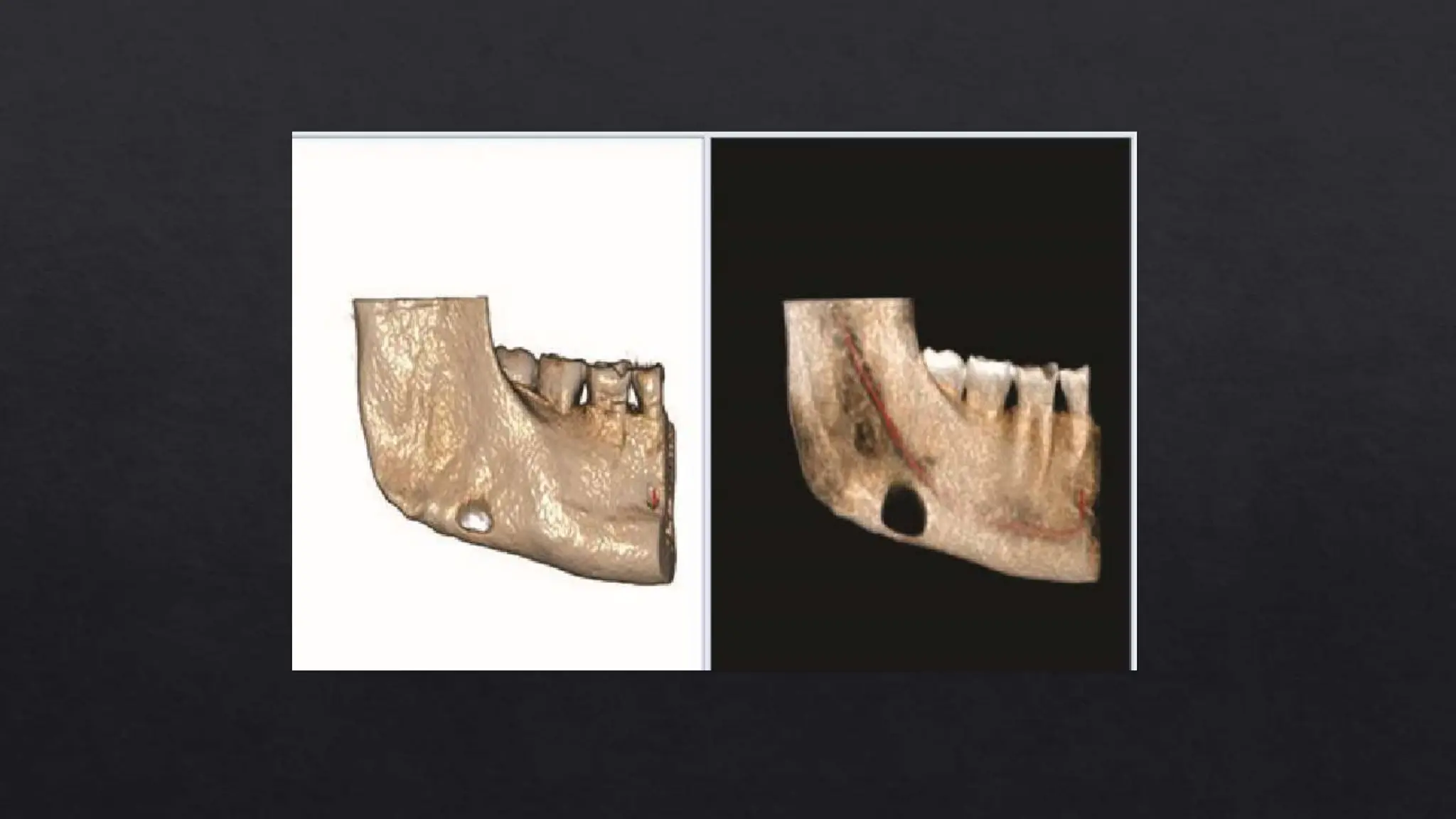 STAFNE'S IDIOPATHIC BONE CAVITY oral pathology | PPT | Free Download