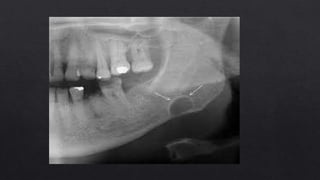 STAFNE'S IDIOPATHIC BONE CAVITY oral pathology | PPTX