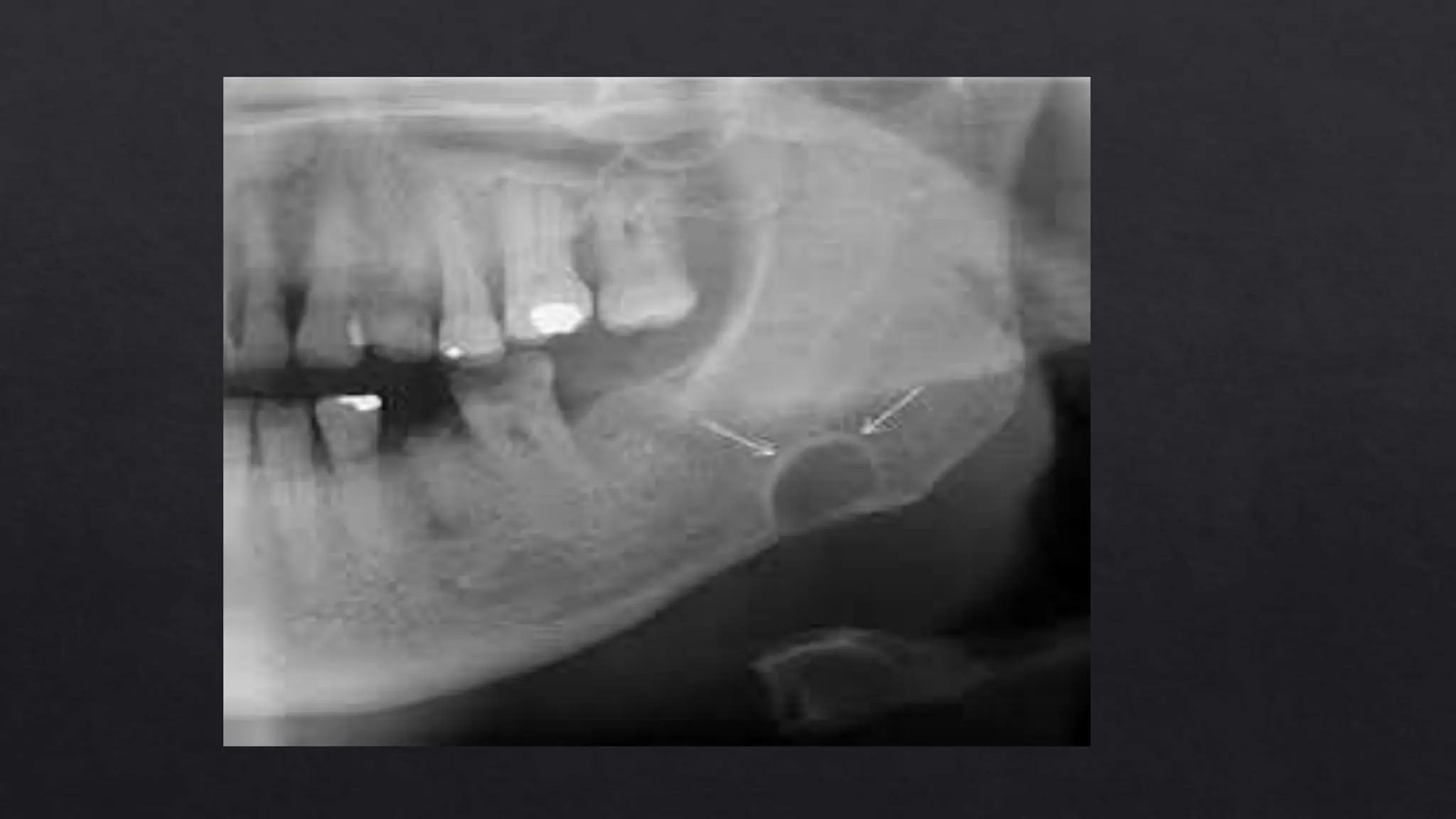 STAFNE'S IDIOPATHIC BONE CAVITY oral pathology | PPTX