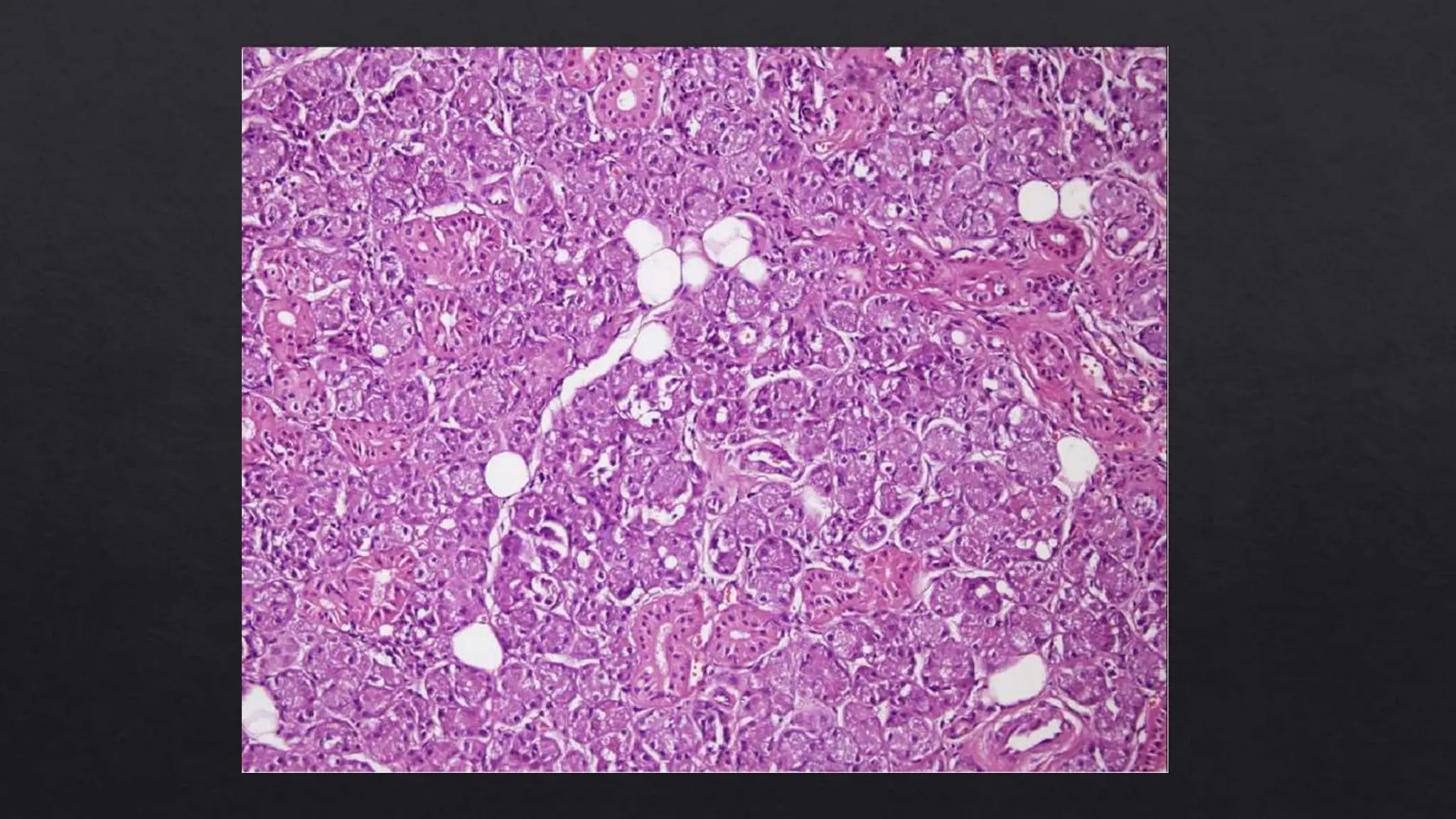STAFNE'S IDIOPATHIC BONE CAVITY oral pathology | PPTX