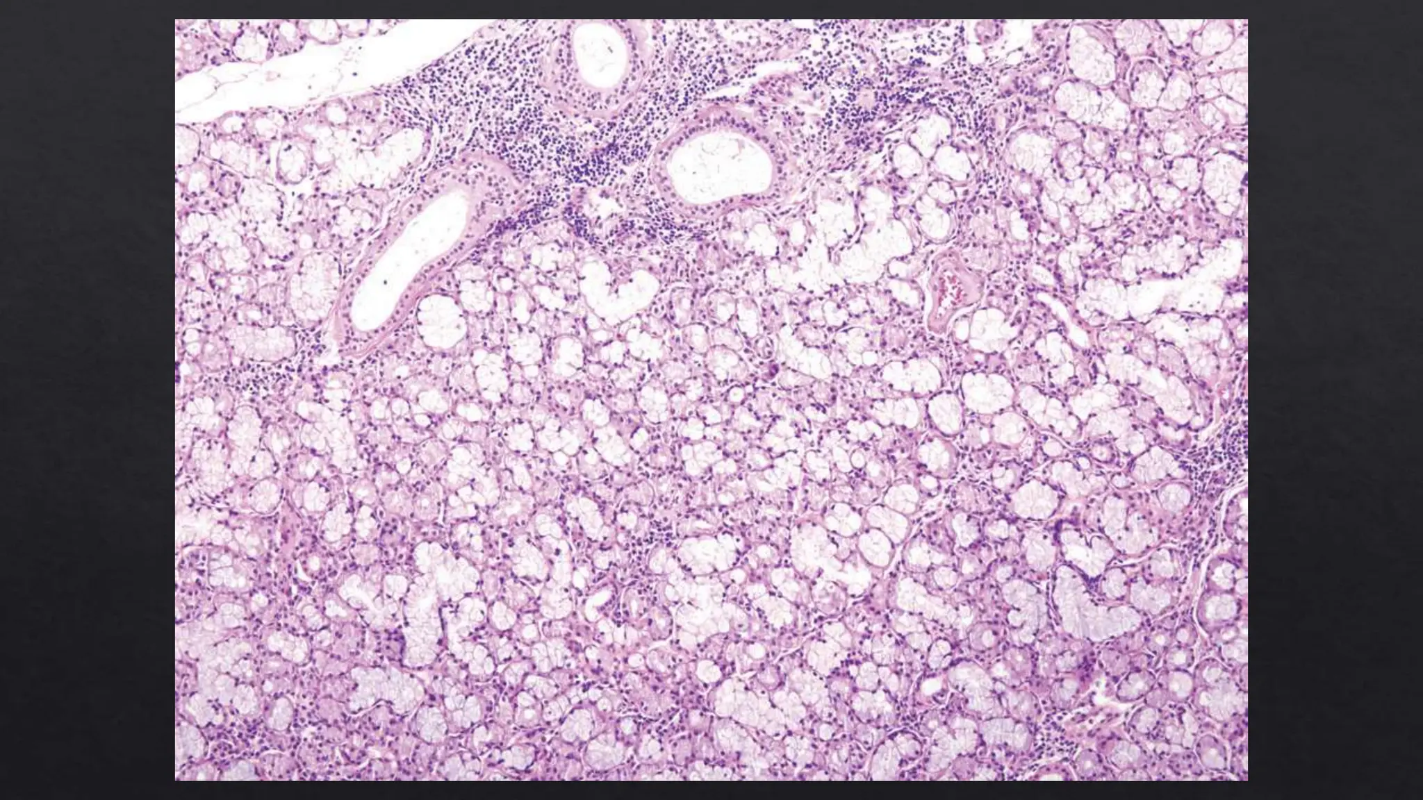 STAFNE'S IDIOPATHIC BONE CAVITY oral pathology | PPTX
