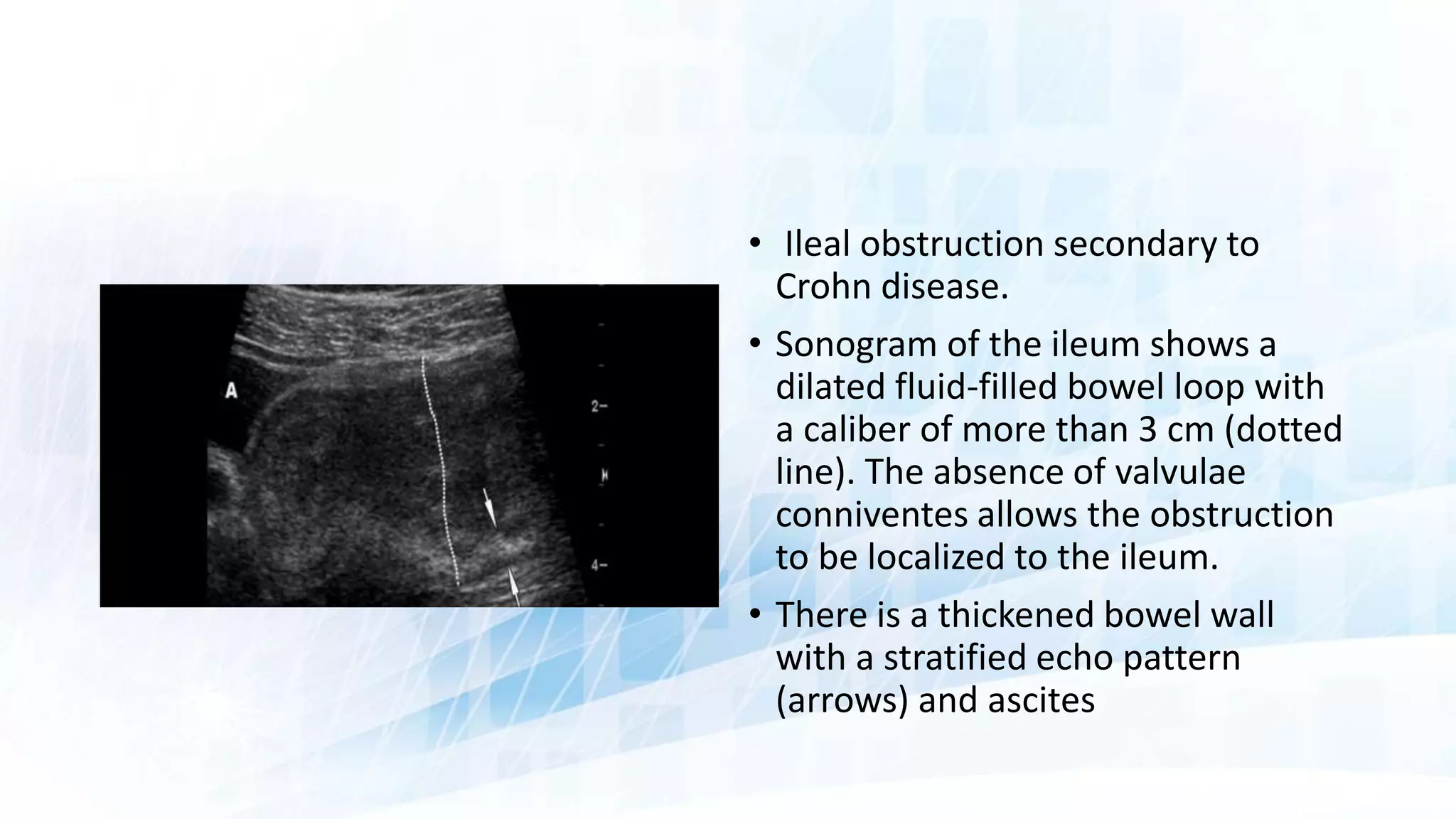 RADIOLOGIC ANATOMY OF SMALL INTESTINE AND INTRODUCTION TO SMALL BOWEL ...