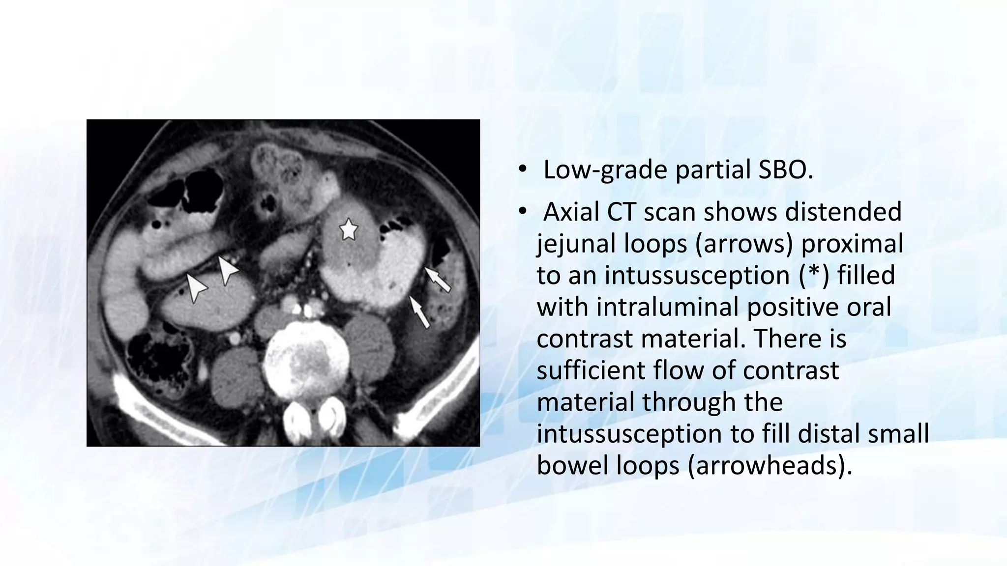 RADIOLOGIC ANATOMY OF SMALL INTESTINE AND INTRODUCTION TO SMALL BOWEL ...