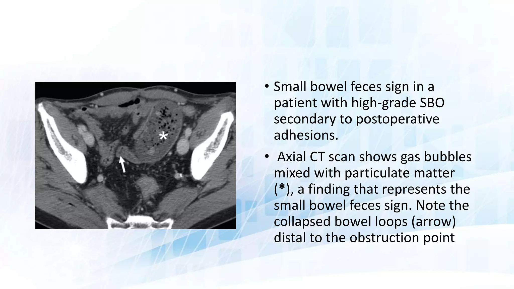 RADIOLOGIC ANATOMY OF SMALL INTESTINE AND INTRODUCTION TO SMALL BOWEL ...