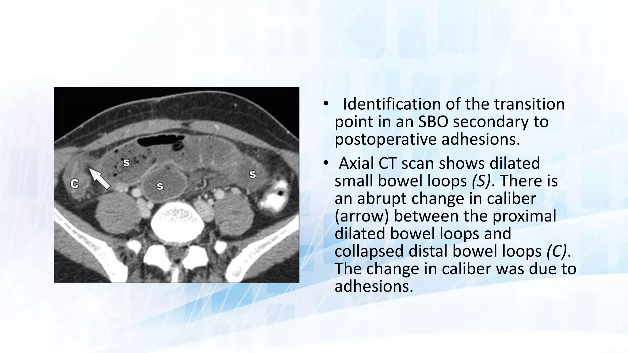 RADIOLOGIC ANATOMY OF SMALL INTESTINE AND INTRODUCTION TO SMALL BOWEL ...