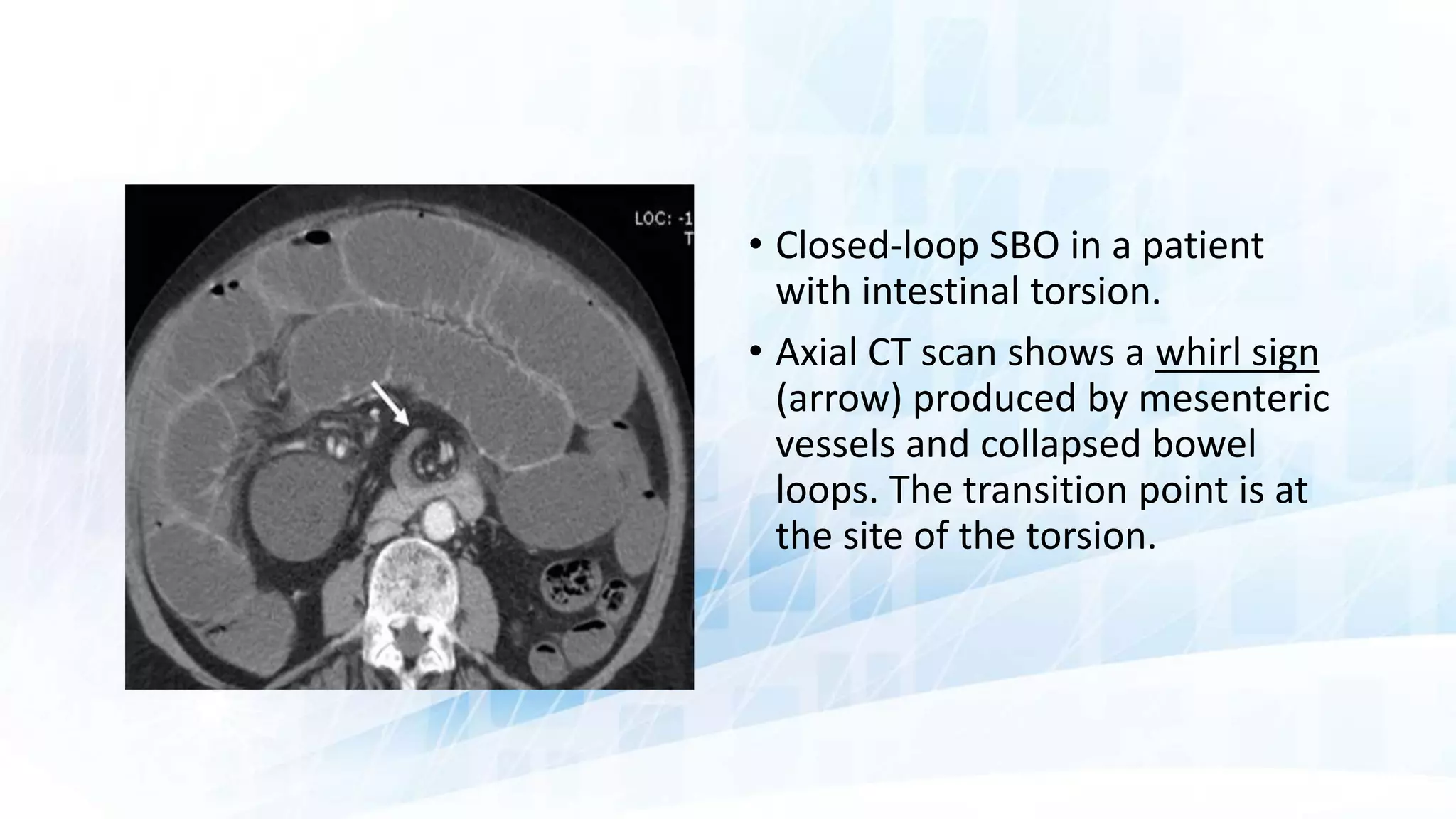 RADIOLOGIC ANATOMY OF SMALL INTESTINE AND INTRODUCTION TO SMALL BOWEL ...