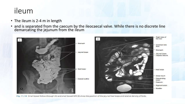 RADIOLOGIC ANATOMY OF SMALL INTESTINE AND INTRODUCTION TO SMALL BOWEL ...