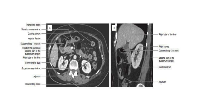 RADIOLOGIC ANATOMY OF SMALL INTESTINE AND INTRODUCTION TO SMALL BOWEL ...