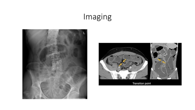 aetiology and management of small bowel obstruction | PPTX