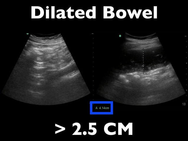 Point of care Intestinal Ultrasound: Lauren Westafer | PDF