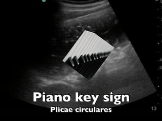 Point of care Intestinal Ultrasound: Lauren Westafer | PDF