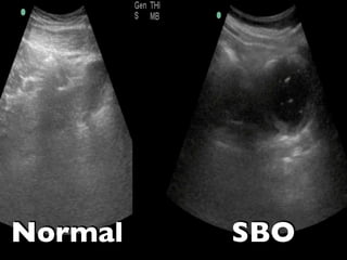 Point of care Intestinal Ultrasound: Lauren Westafer | PDF