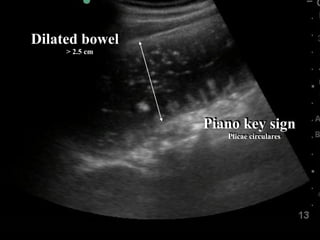 Point of care Intestinal Ultrasound: Lauren Westafer | PDF