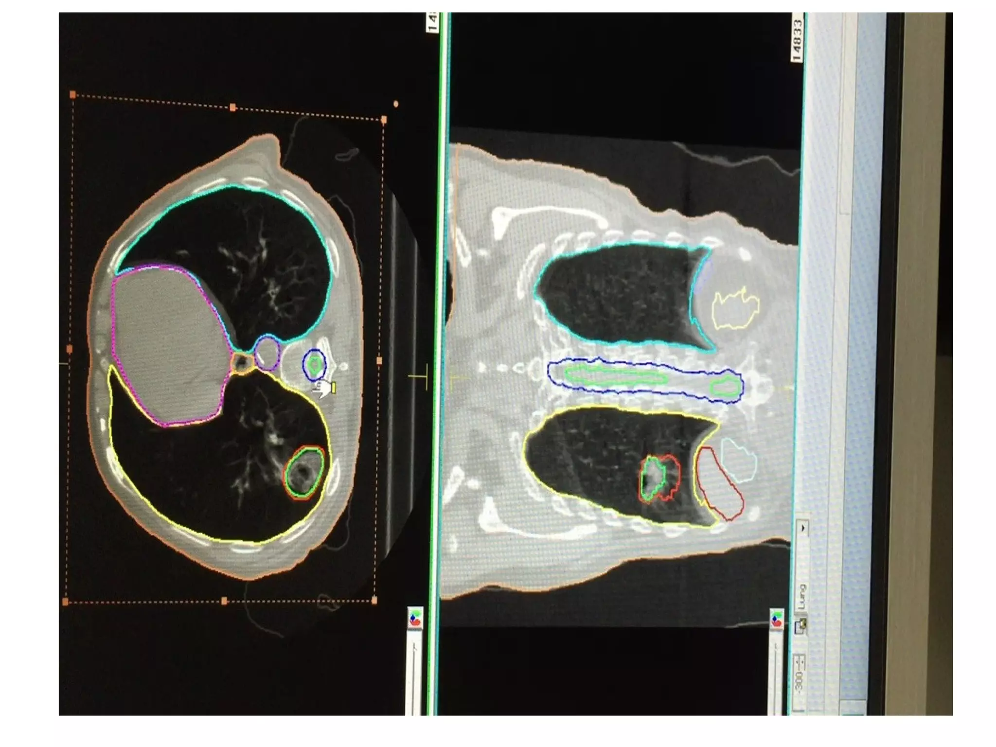 SBRT Contouring Guidelines | PPT