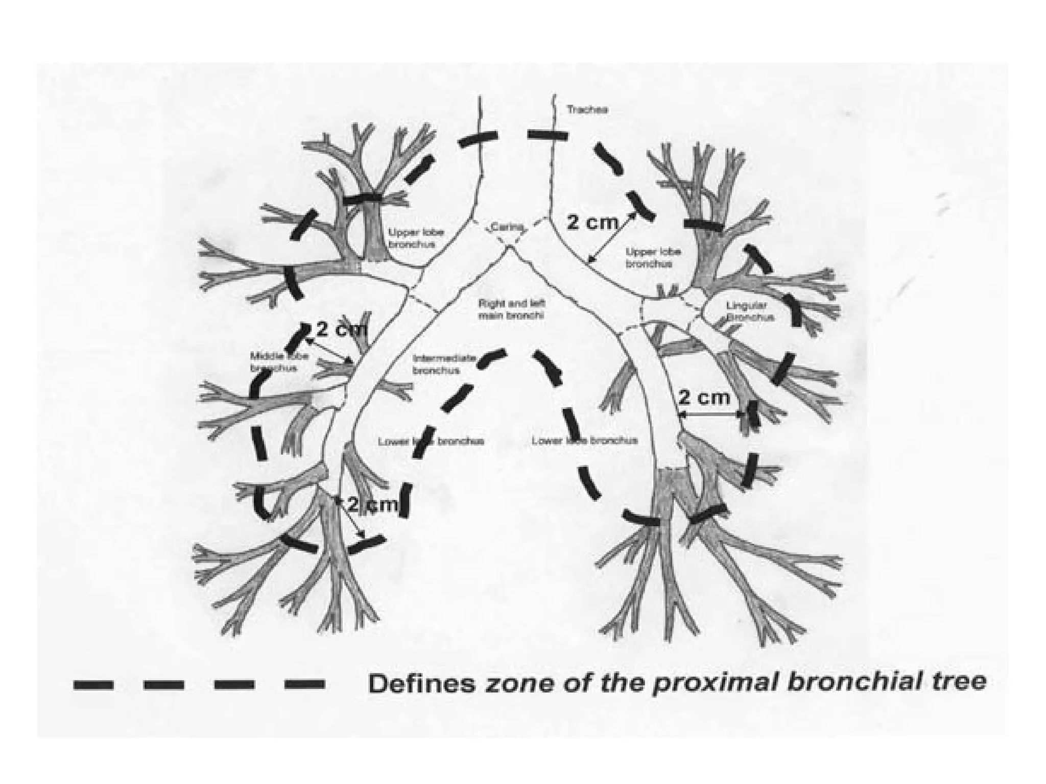 SBRT Contouring Guidelines | PPT