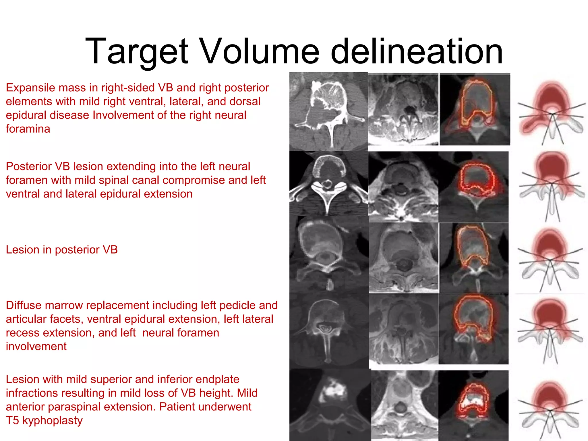 SBRT Contouring Guidelines | PPT