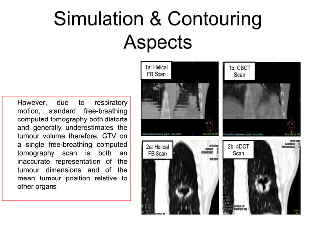 SBRT Contouring Guidelines | PPT