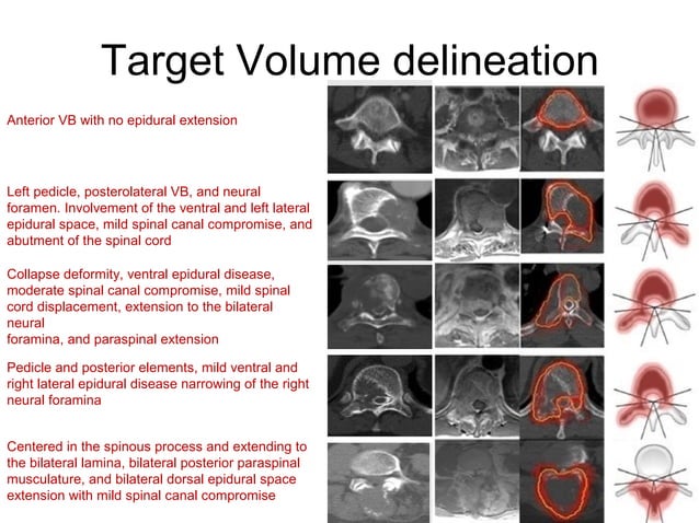 SBRT Contouring Guidelines