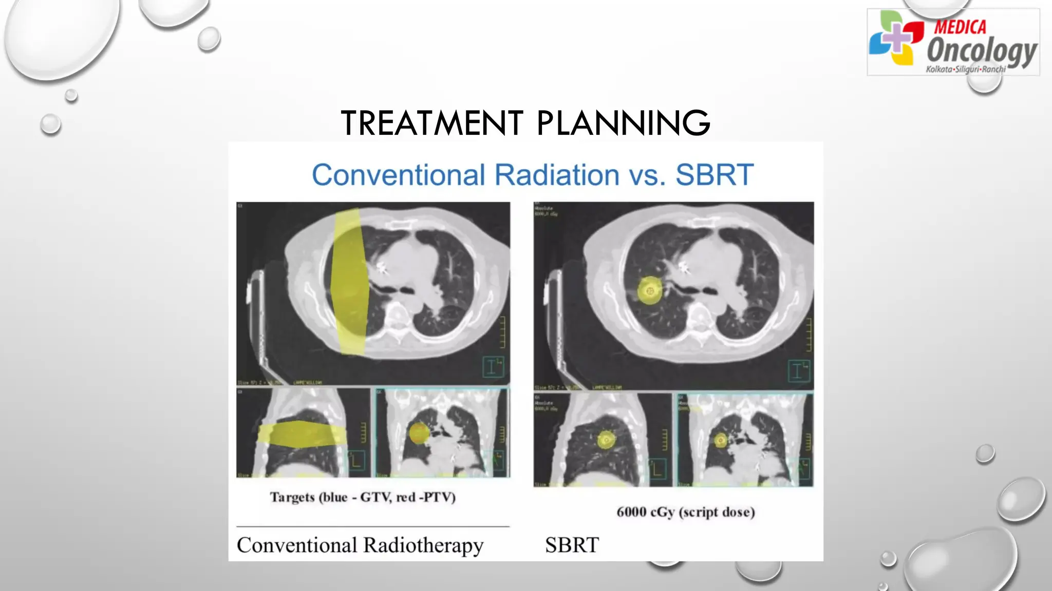 SBRT (Stereotactic Body Radiation Therapy in Lung Cancer.pptx