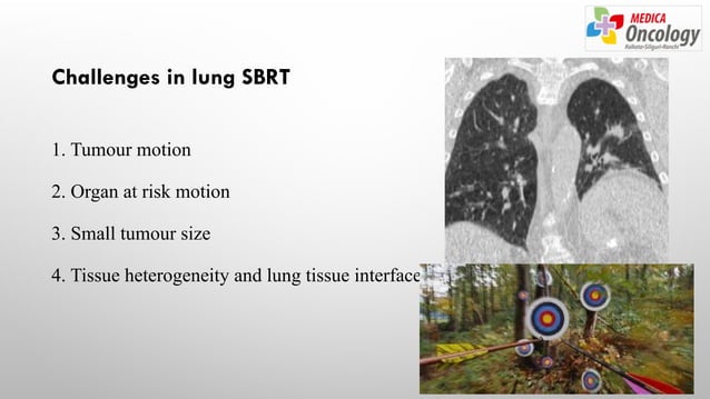 SBRT (Stereotactic Body Radiation Therapy in Lung Cancer.pptx