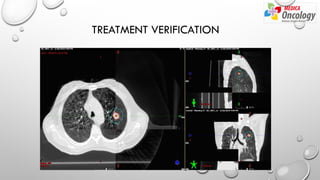 SBRT (Stereotactic Body Radiation Therapy in Lung Cancer.pptx