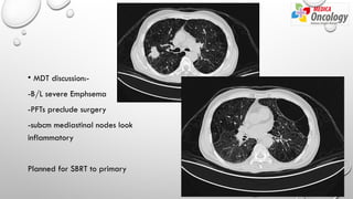 SBRT (Stereotactic Body Radiation Therapy in Lung Cancer.pptx