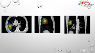 SBRT (Stereotactic Body Radiation Therapy in Lung Cancer.pptx