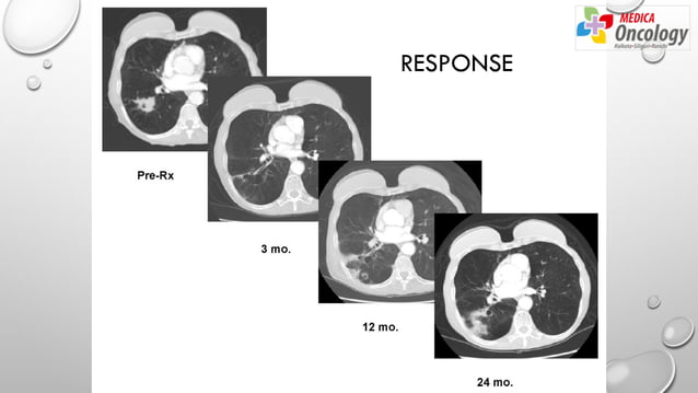 SBRT (Stereotactic Body Radiation Therapy in Lung Cancer.pptx