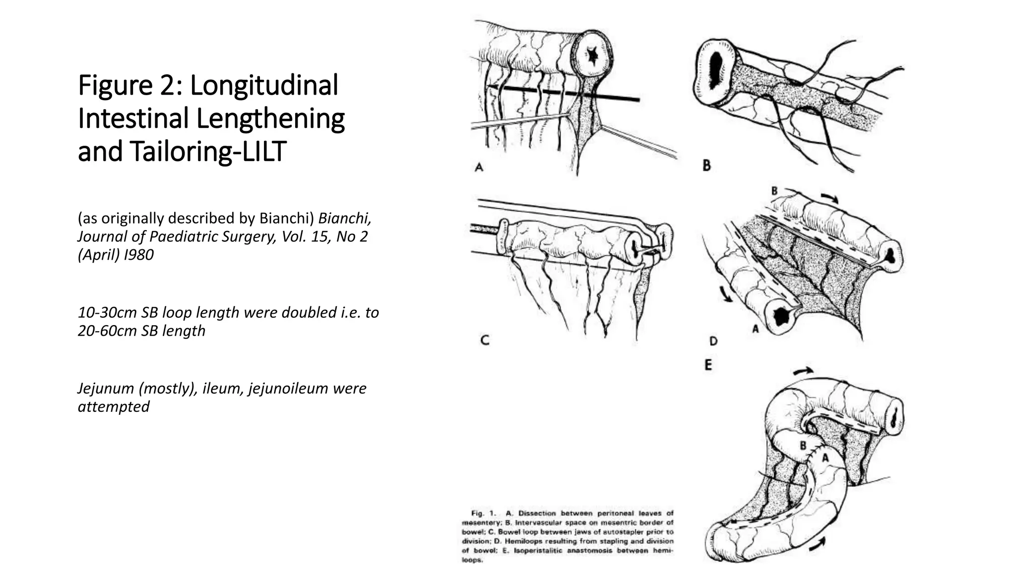 Short Bowel Syndrome | PPTX