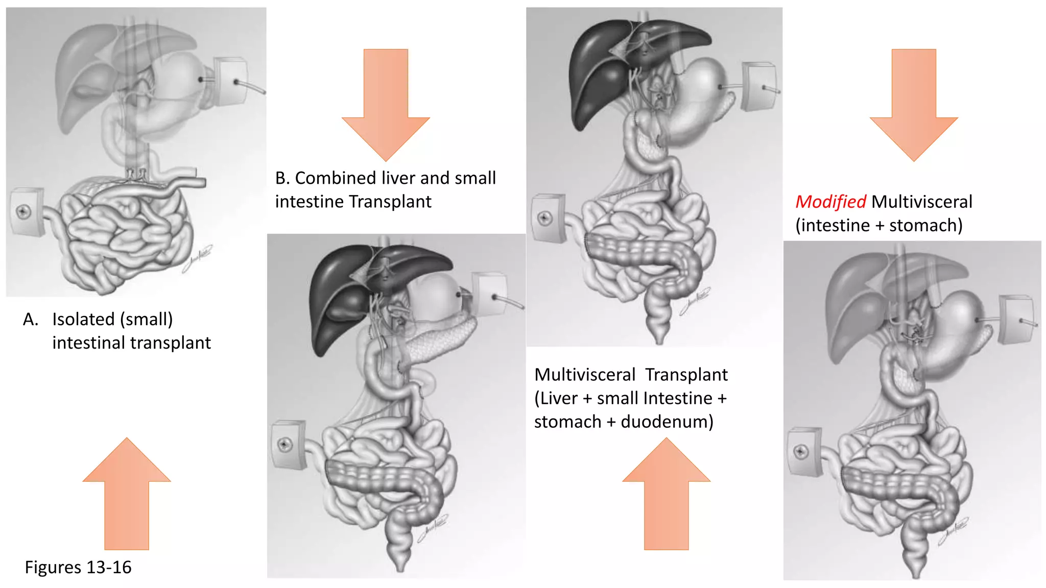 Short Bowel Syndrome | PPTX