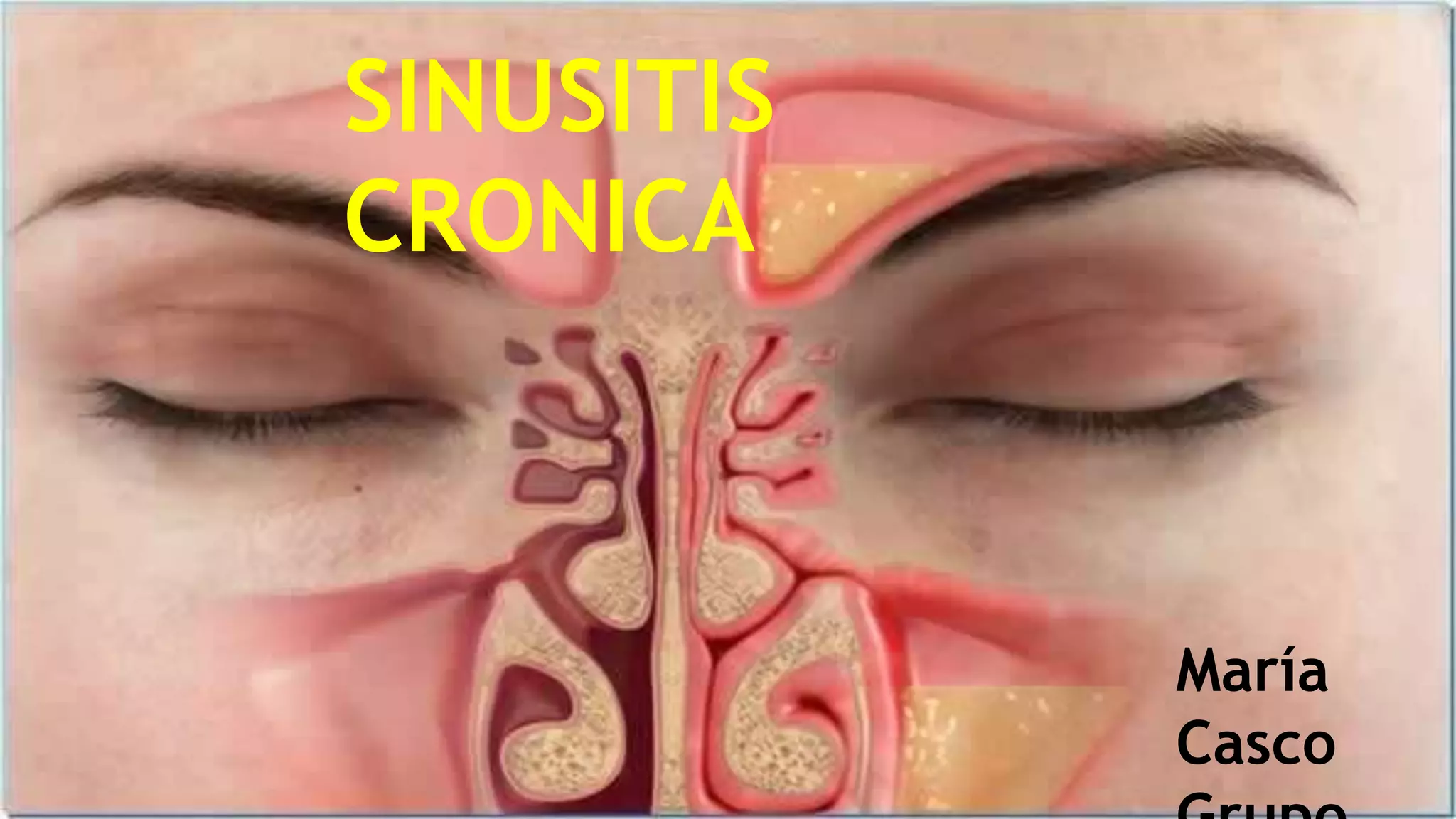 Sinusitis Cronica Pptx