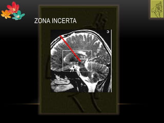 SCA 12| DBS Surgery| Neurological Surgery| Dr Paresh Doshi | PPT